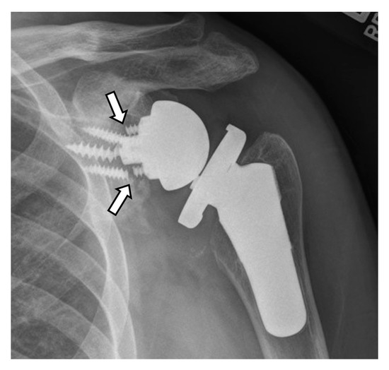 Update on Shoulder Arthroplasties with Emphasis on Imaging