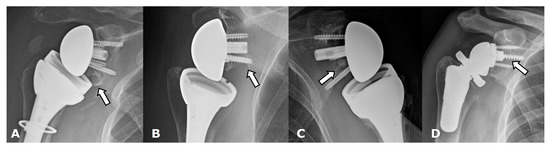 Update on Shoulder Arthroplasties with Emphasis on Imaging