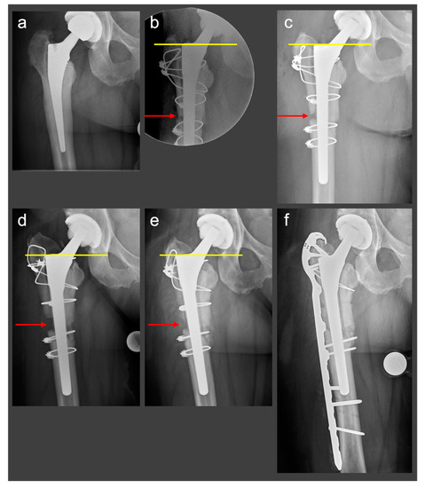A Monocortical Screw for Preventing Trochanteric Escape in Extended ...