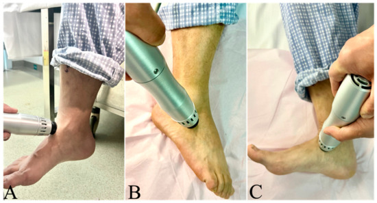 The Efficacy of Microfracture Combined with Extracorporeal Shock Wave ...