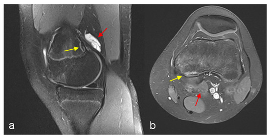 Cortical Desmoid of the Distal Femur—Incidentaloma or Insertional ...