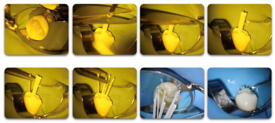 Stronger than Ever: Multifilament Fiberglass Posts Boost Maxillary ...