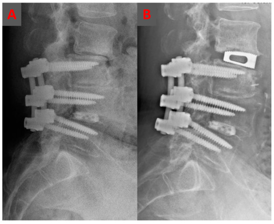 JCM | Free Full-Text | Stand-Alone Oblique Lumbar Interbody Fusion ...