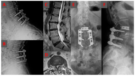 Stand-Alone Oblique Lumbar Interbody Fusion (OLIF) for the Treatment of ...