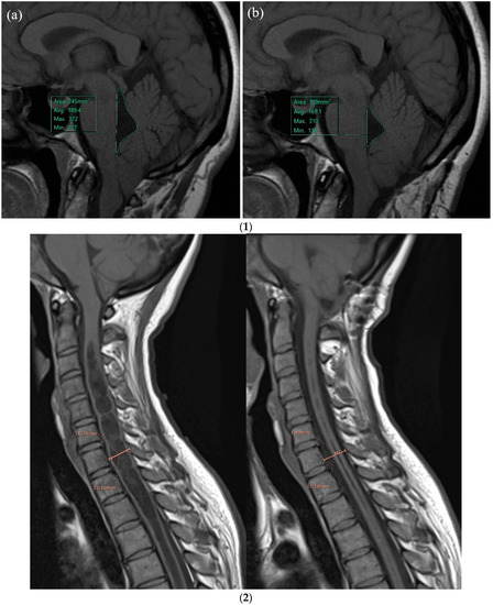JCM | Free Full-Text | Syringomyelia Associated with Chiari 1 ...