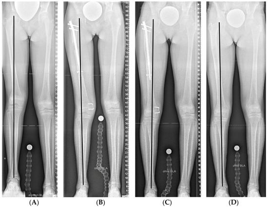 Antegrade Intramedullary Femoral Lengthening and Distal Temporary Hemiepiphysiodesis for ...
