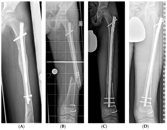 Antegrade Intramedullary Femoral Lengthening and Distal Temporary ...