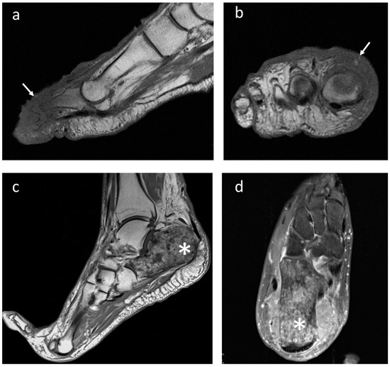Malignant Bone and Soft Tissue Lesions of the Foot