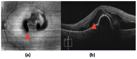 Prognostic Optical Coherence Tomography Biomarkers in Neovascular Age ...