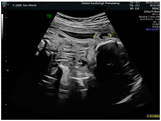 Measurement of the Fetal Ear Length Has No Clinical Value