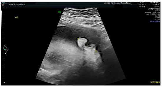 Measurement of the Fetal Ear Length Has No Clinical Value