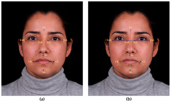 Accuracy between 2D Photography and Dual-Structured Light 3D Facial ...