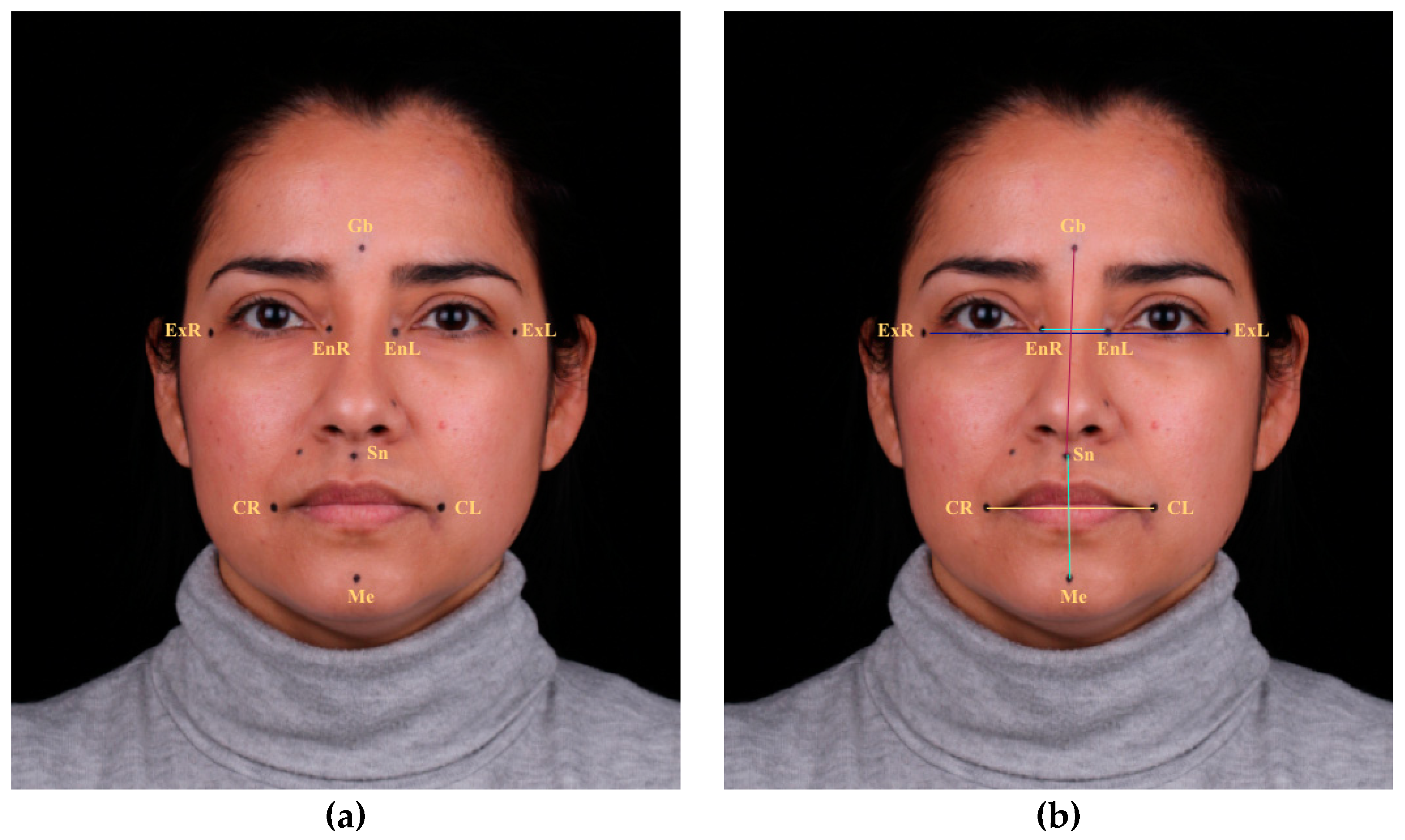 Accuracy between 2D Photography and Dual-Structured Light 3D Facial Scanner for Facial ...