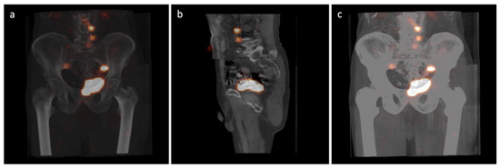 JCM | Free Full-Text | Diagnostic Value of the Sentinel Lymph Node ...