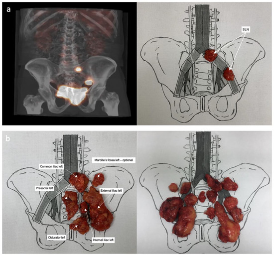 JCM | Free Full-Text | Diagnostic Value of the Sentinel Lymph Node ...