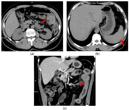 Intramural Hematoma of Gastrointestinal Tract in People with Hemophilia ...