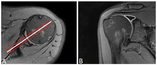 3-Tesla T2 Mapping Magnetic Resonance Imaging for Evaluation of SLAP ...