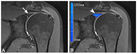 3-Tesla T2 Mapping Magnetic Resonance Imaging for Evaluation of SLAP ...
