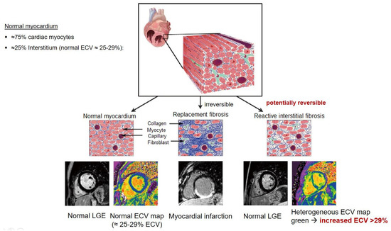 JCM | Free Full-Text | Hypertensive Heart Disease—The Imaging Perspective