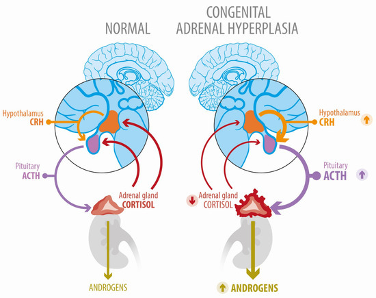 Clinical Update on Congenital Adrenal Hyperplasia: Recommendations from a Multidisciplinary ...