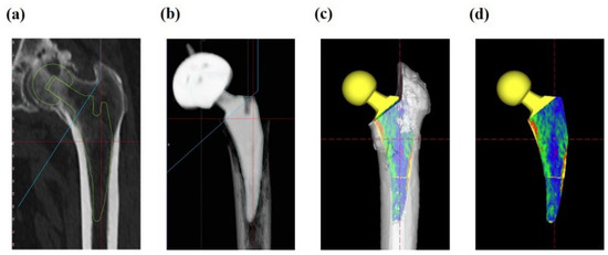 Relationship between Stress Shielding and Optimal Femoral Canal Contact ...