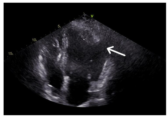 Congenital Ventricular Diverticulum