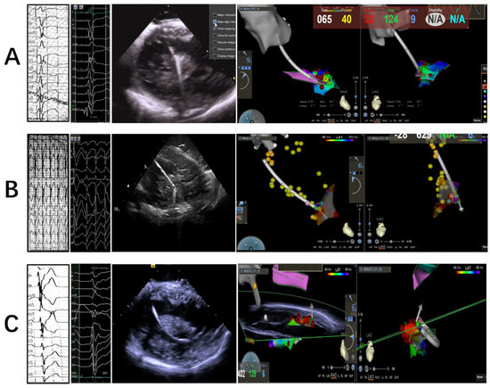 Combination of Intracardiac Echocardiography and Contact Force Sensing ...