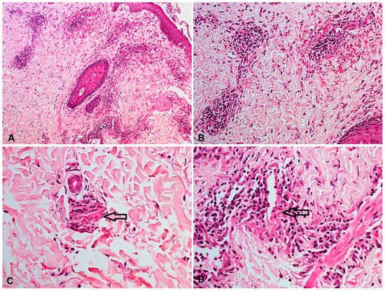 Leukocytoclastic Vasculitis Secondary to Anti-Tumor Necrosis Factor ...