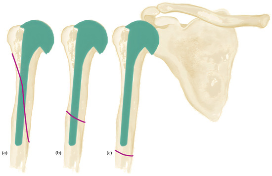 Inter-Observer and Intra-Observer Reliability Assessment of the ...