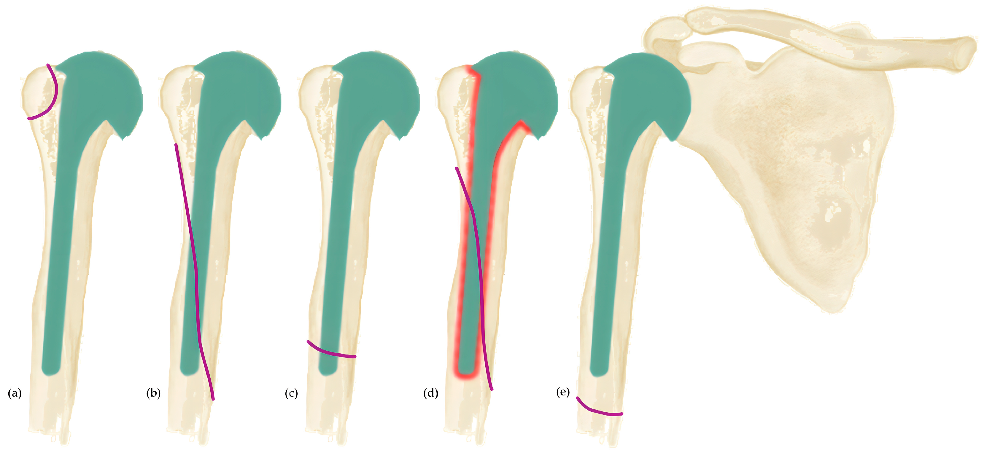 Inter-Observer and Intra-Observer Reliability Assessment of the ...