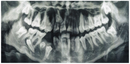 Tooth Migration in a Female Patient with Hyperdontia: 11-Year Follow-Up ...
