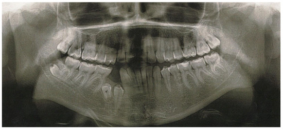 Tooth Migration in a Female Patient with Hyperdontia: 11-Year Follow-Up ...