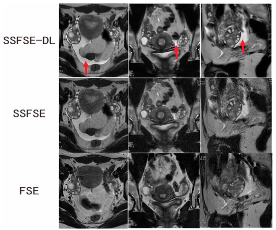 High-Resolution Single-Shot Fast Spin-Echo MR Imaging with Deep Learning Reconstruction ...