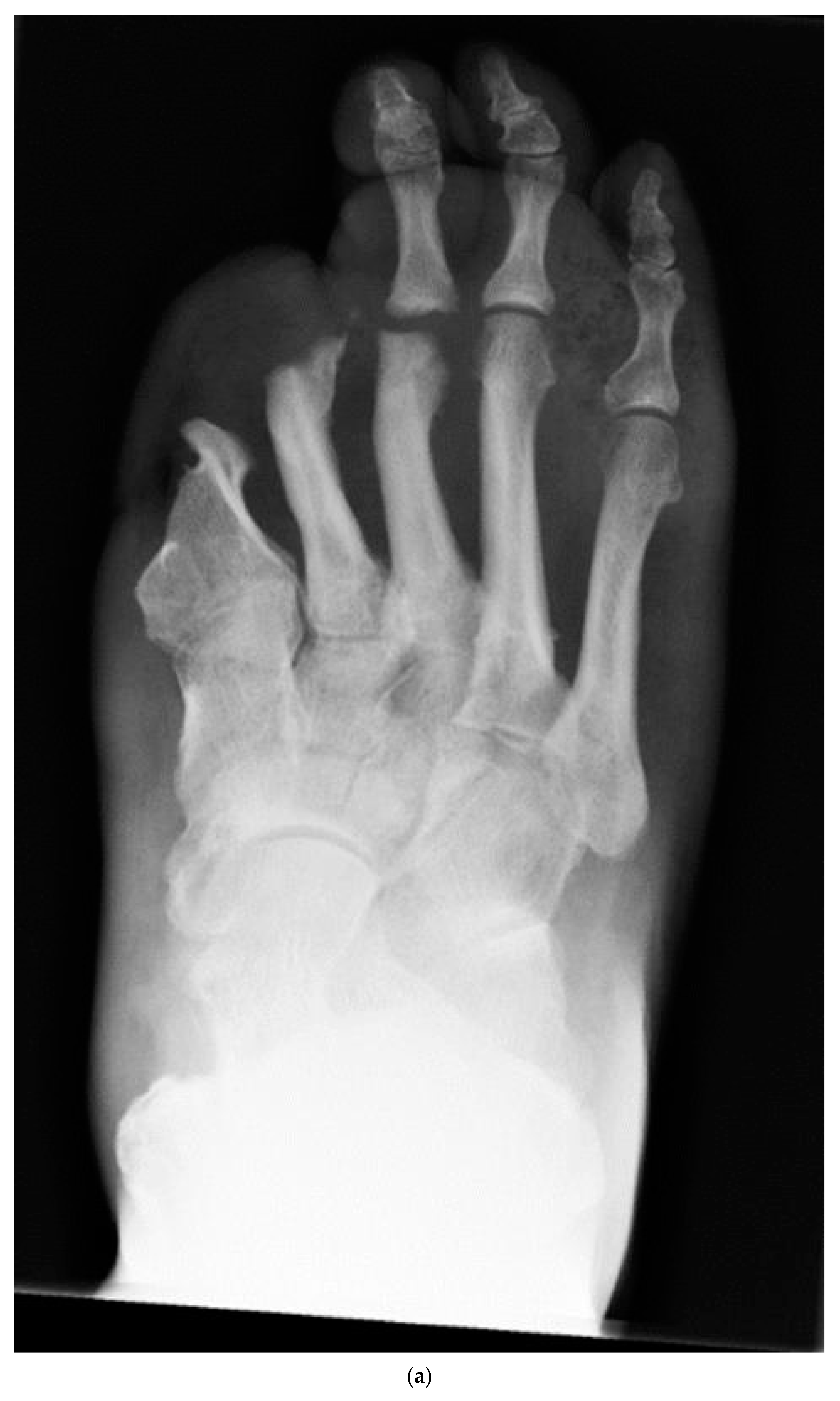 Osteomyelitis Bone Scan Osteomyelitis Bone Scan