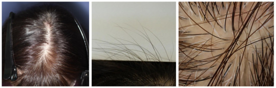 Recent Advances in Understanding of the Etiopathogenesis, Diagnosis ...