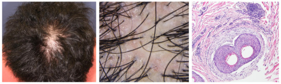 Recent Advances in Understanding of the Etiopathogenesis, Diagnosis ...