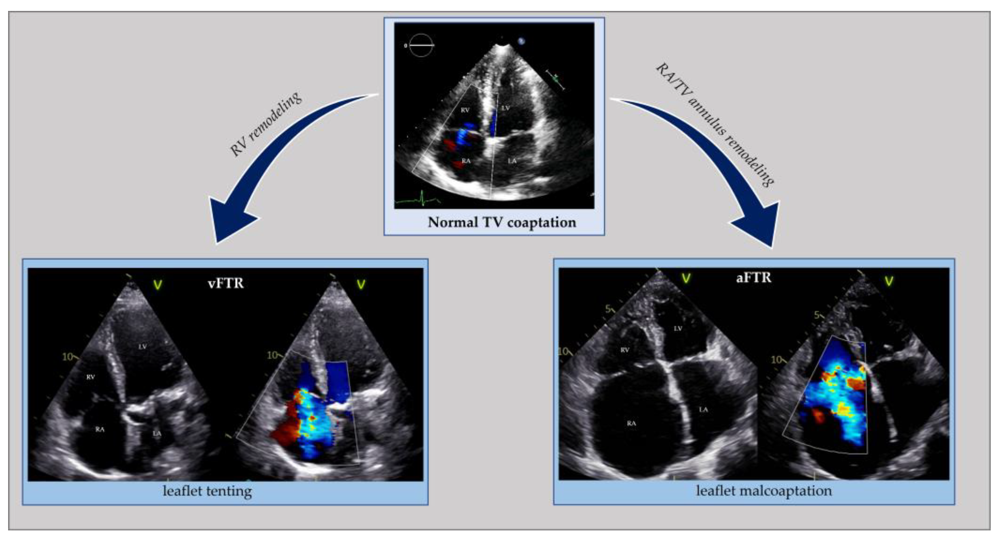 Functional Mitral Regurgitation And Tricuspid Regurgitation