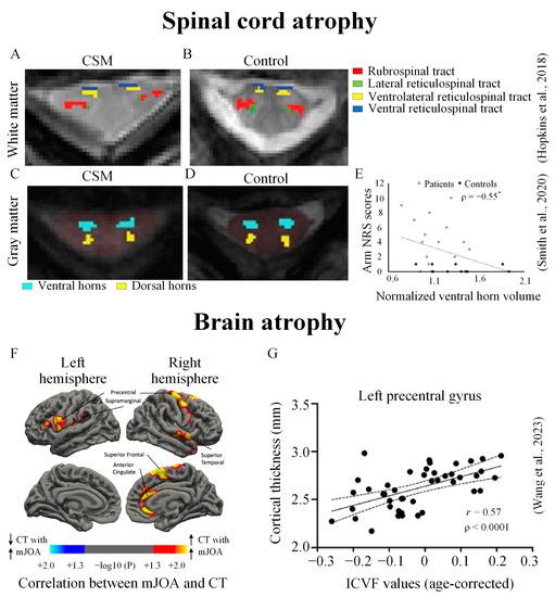 Utility of MRI in Quantifying Tissue Injury in Cervical Spondylotic ...