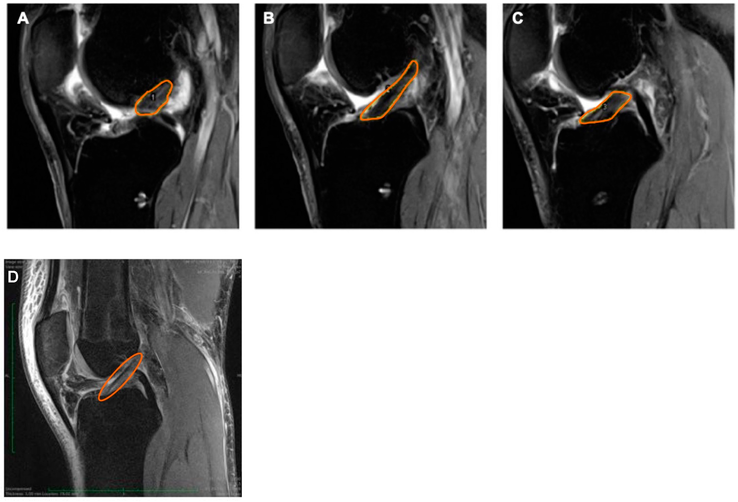 Extracorporeal Shockwave Therapy Improves Outcome after Primary Anterior Cruciate Ligament ...