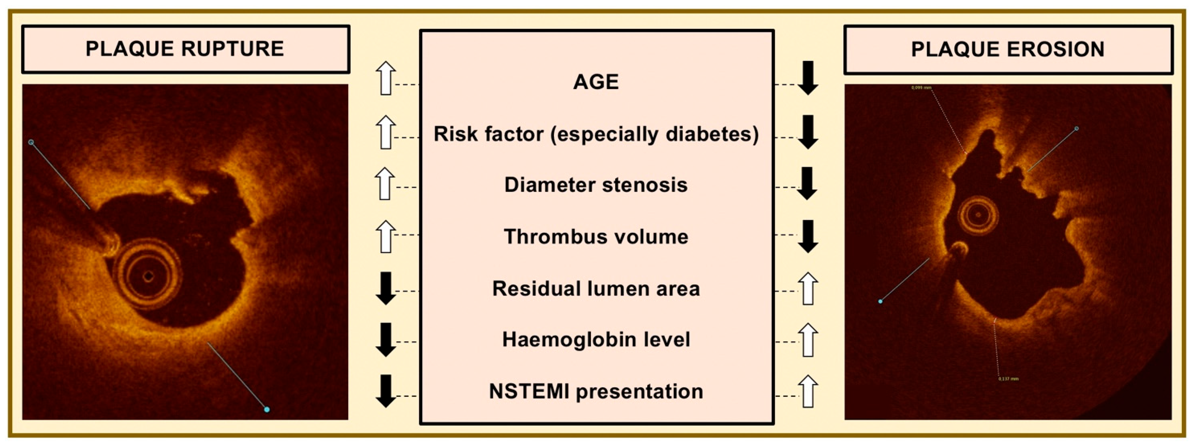 JCM | Free Full-Text | Current Role of Intracoronary Imaging for Implementing Risk ...