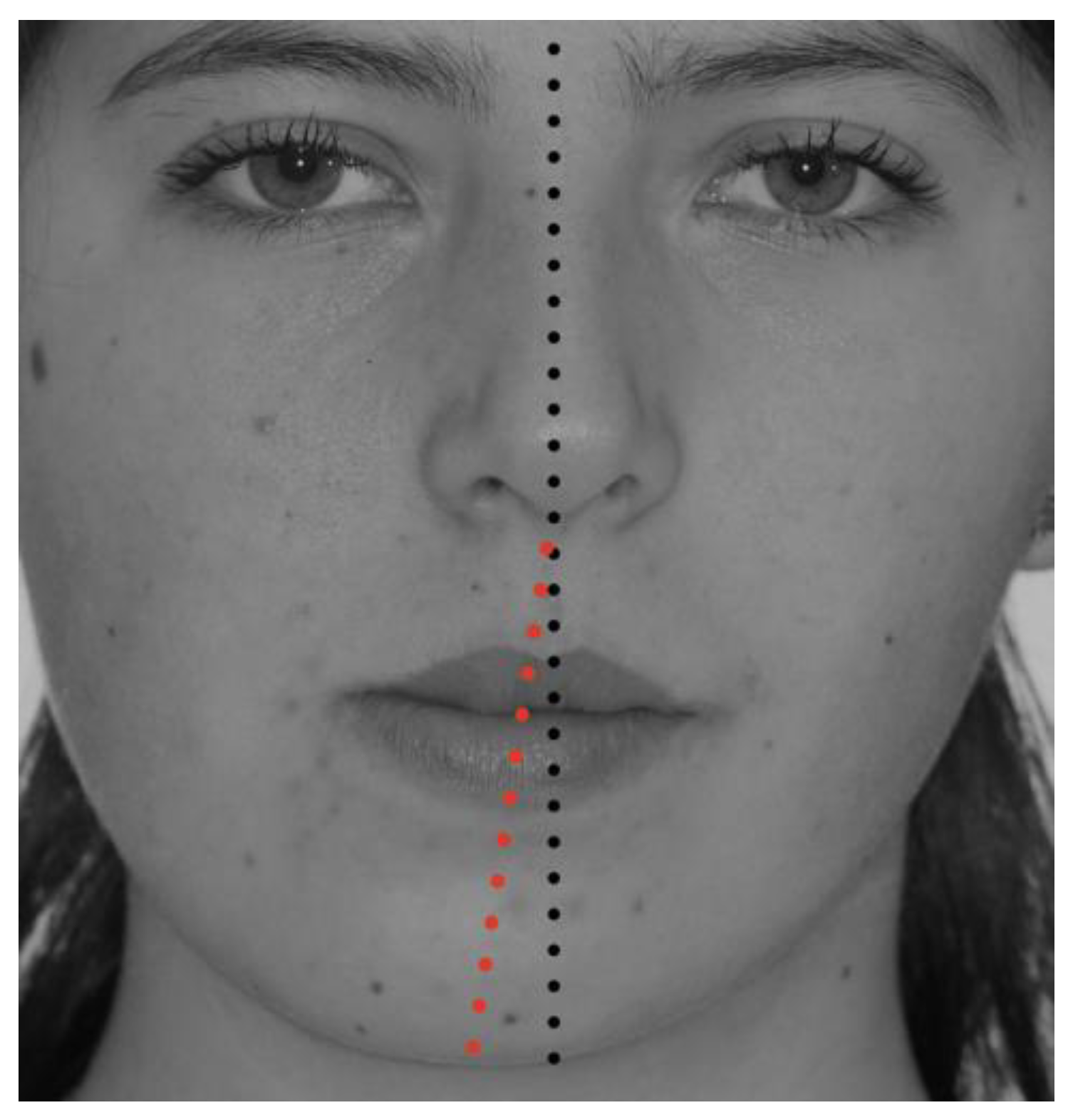 Early Treatment of Unilateral Condylar Hyperplasia in Adolescents ...