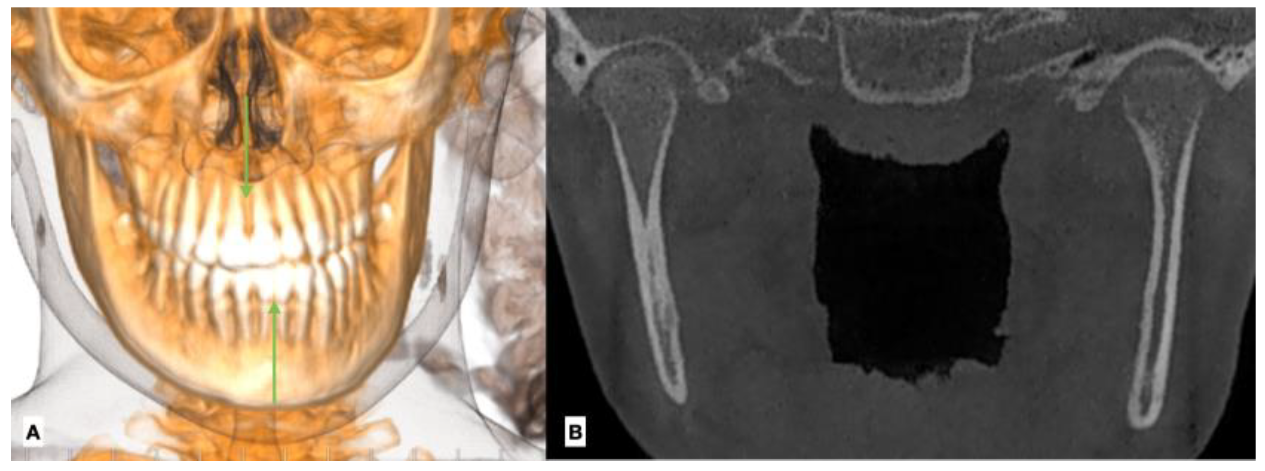 Early Treatment of Unilateral Condylar Hyperplasia in Adolescents ...