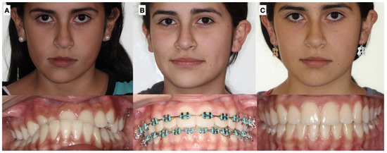 Early Treatment of Unilateral Condylar Hyperplasia in Adolescents ...