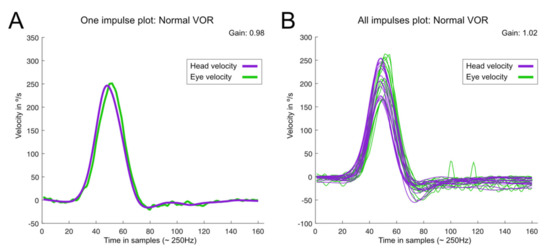A Paradoxical Clinical Coincidence: Benign Paroxysmal Positional ...