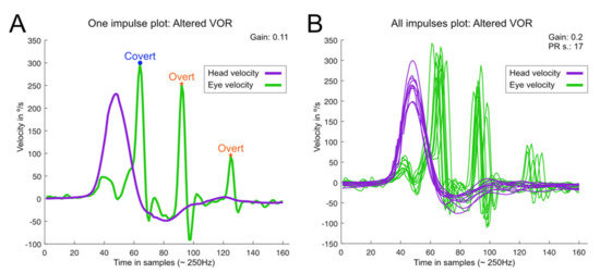 A Paradoxical Clinical Coincidence: Benign Paroxysmal Positional ...