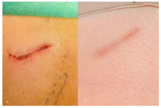 Minimally Invasive Harvesting Technique for Costal Cartilage Graft ...