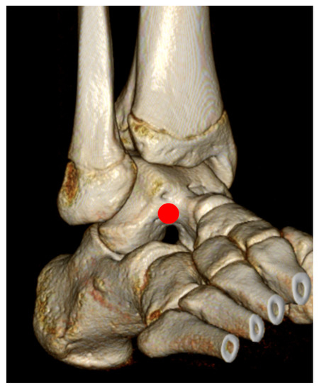 Retrograde Autologous Talar Osteocancellous Bone Grafting for the ...