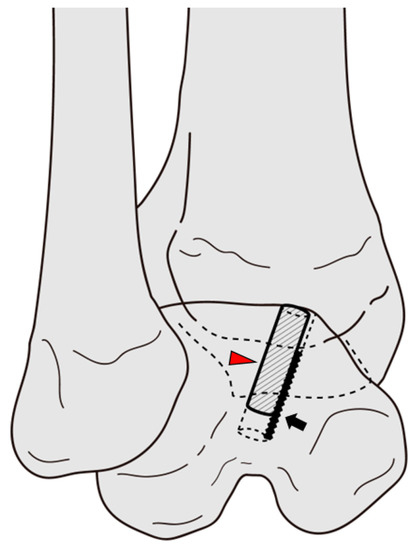 Retrograde Autologous Talar Osteocancellous Bone Grafting for the ...