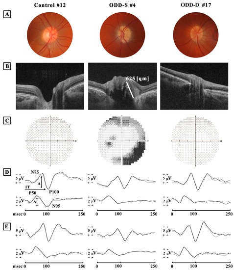 Morpho-Functional Assessment of Retinal Ganglion Cells and Visual ...