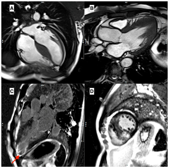 Cardiac Magnetic Resonance in HCM Phenocopies: From Diagnosis to Risk ...